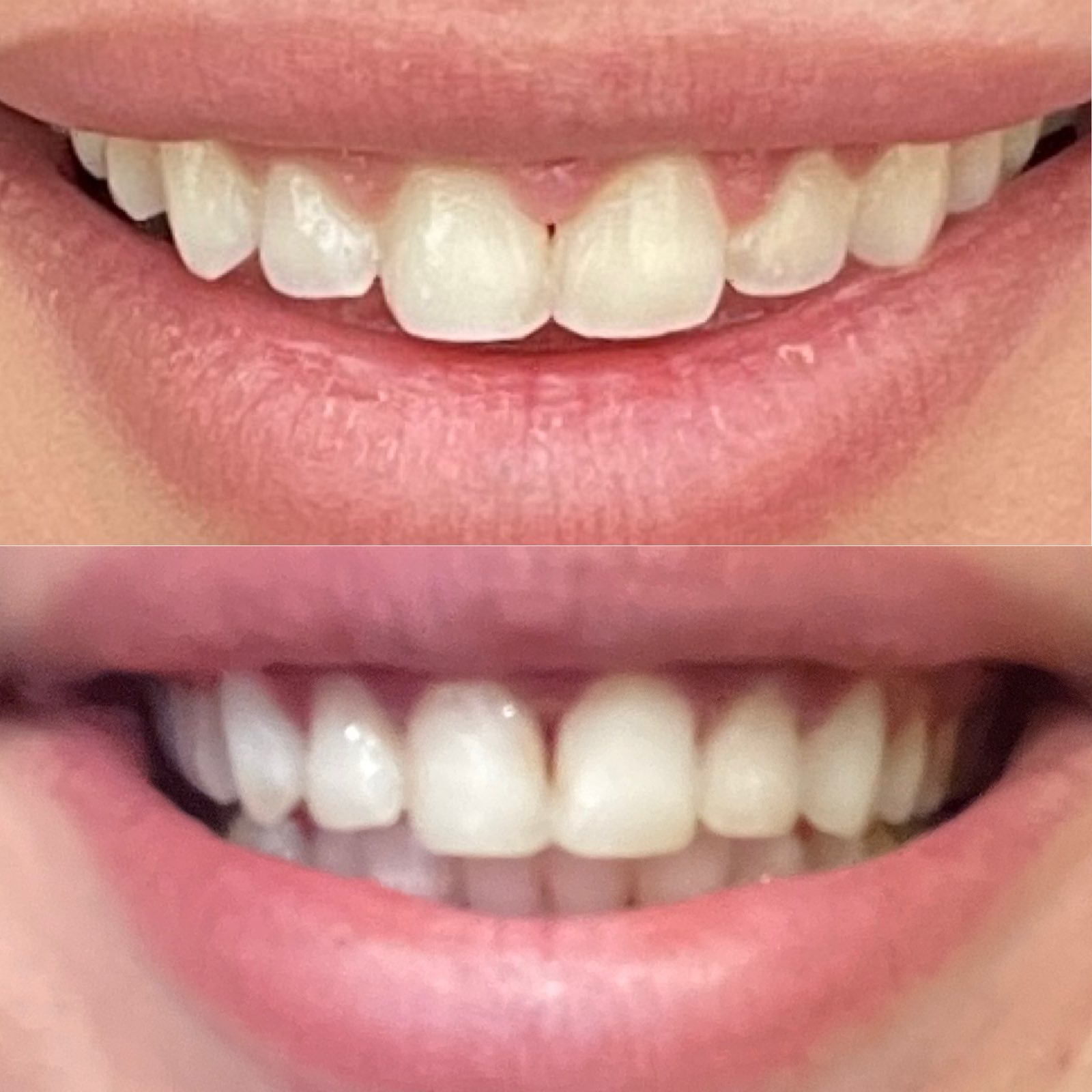 Fasete i porcelanski viniri - Osmeh iz snova | Dental Čigota