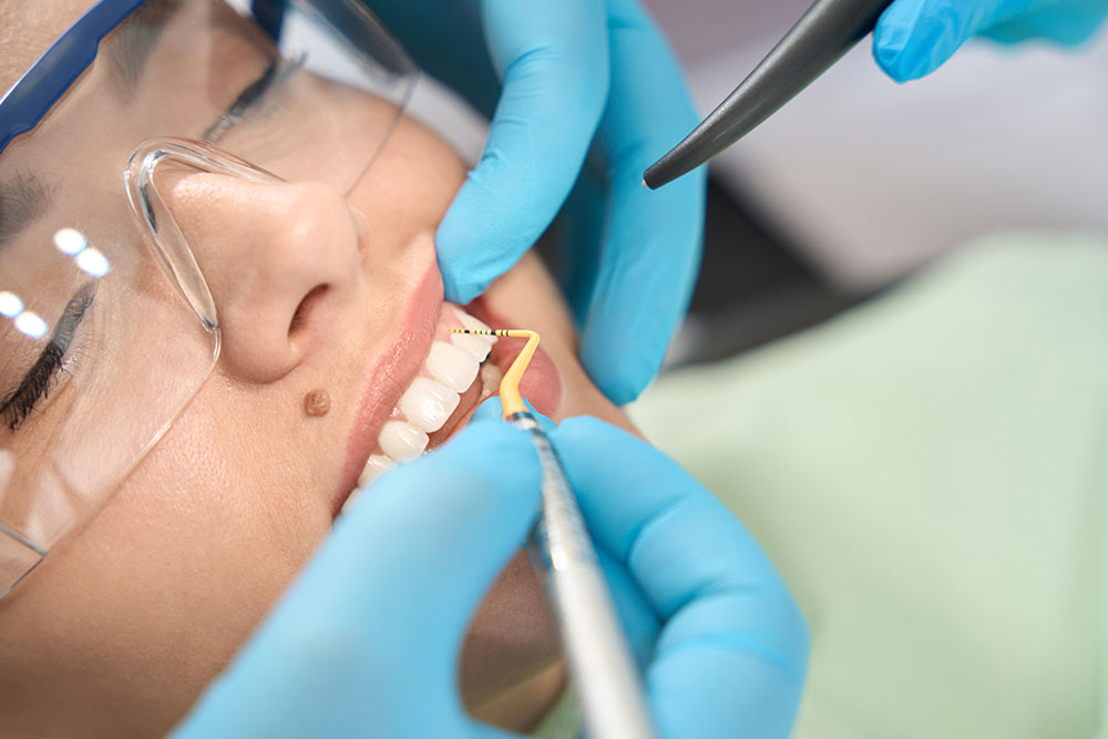 Skidanje kamenca sa zuba | Dental Čigota